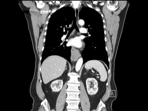 Esophagus- Leiomyoma distal esophagus, coronal CT