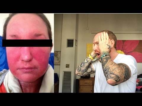 Topical Steroid Withdrawal Syndrome / What to Do about it