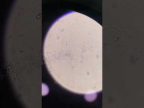 Fungal stain budding yeast cells and pseudohyphae, epithelial cells in sputum, Candida #fungal
