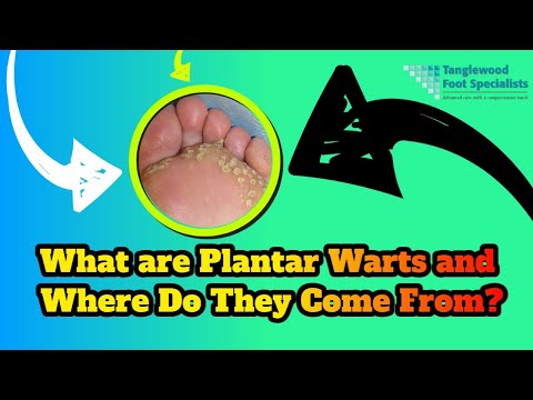 What are Plantar Warts and Where Do They Come From?