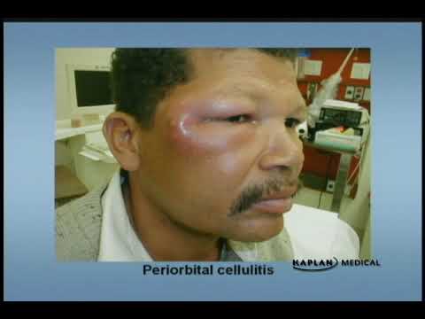 48 Periorbital Versus Orbital Cellulitis FIX