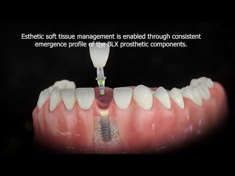 Straumann® BLX Implant System - Consistent Emergence Profile