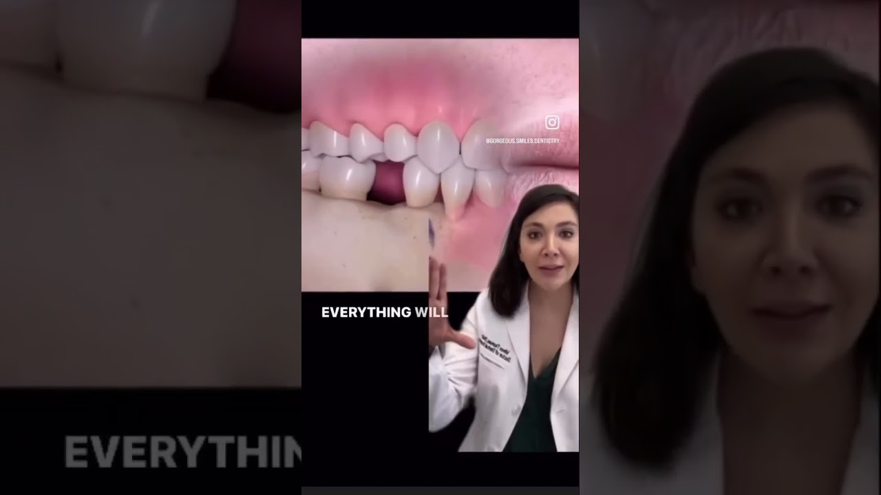 Why Should I Replace A Missing Tooth?