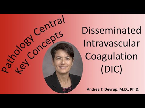 Medical School Pathology: Pathophysiology of Disseminated Intravascular Coagulation (DIC)