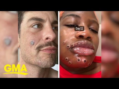 This is what it’s like living with monkeypox