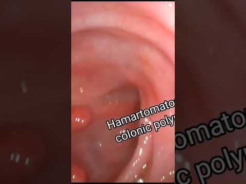 Hamartomatous colonic polyps