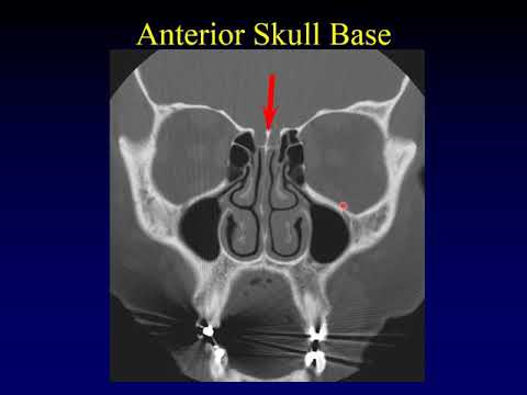 Imaging of the Paranasal Sinuses 1