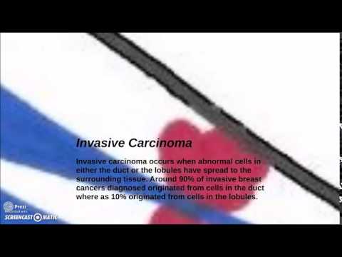 Unravelling the Complexity: Types of Breast Cancer | Breast Cancer ...