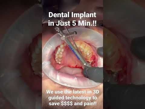 Dental Implant placed in less than 5 Minutes without expensive sedation and painful incisions!