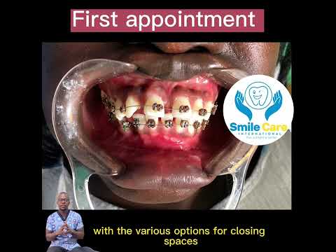 Spaced teeth? Options of treatment include braces. #dental #uganda #braces #kampalacity #like