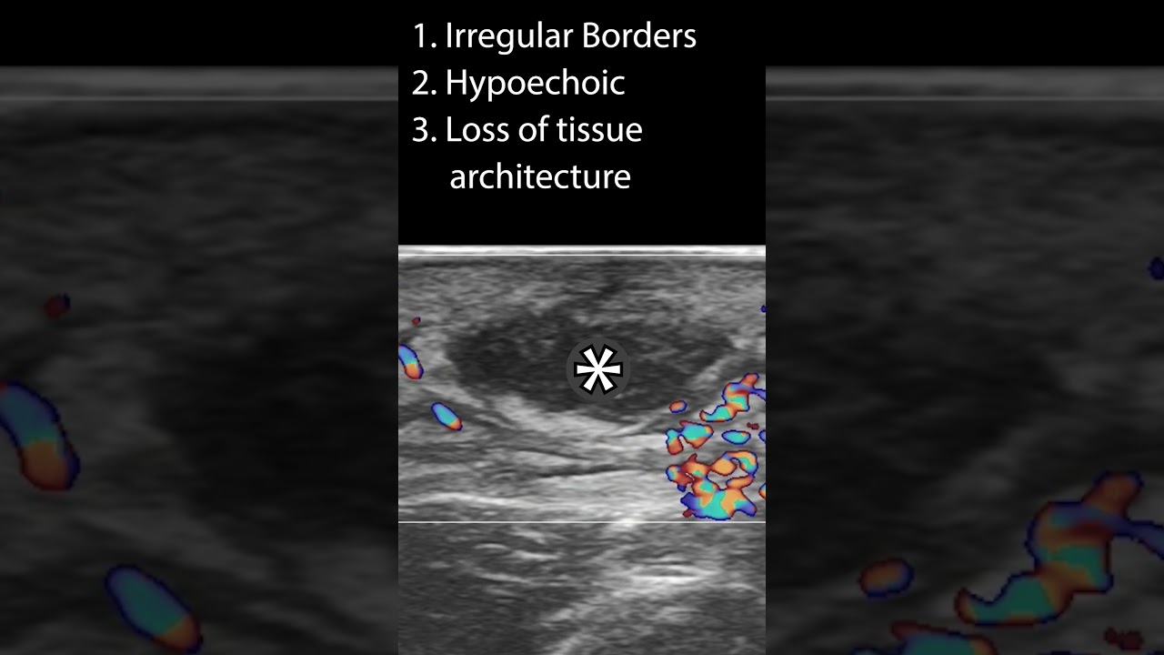 Characteristics of an Abscess  #pocus #ultrasound