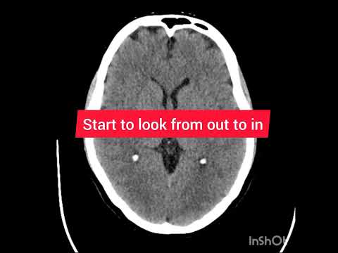 CT Brain #radiology made easy