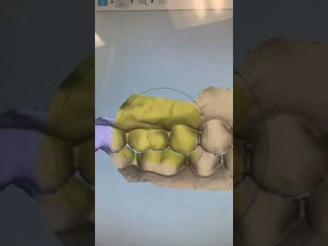 Digital Dental Impressions for Invisalign