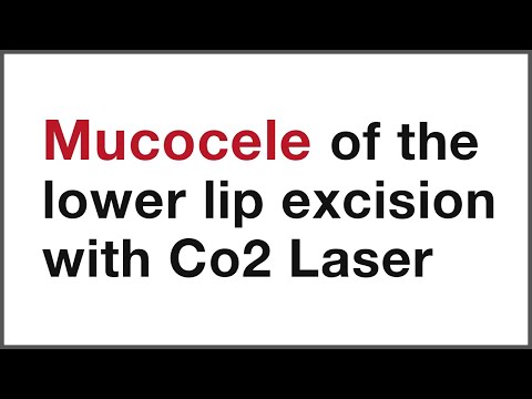 Mucocele of the lower lip excision with Co2 Laser by Dr S Girish Rao