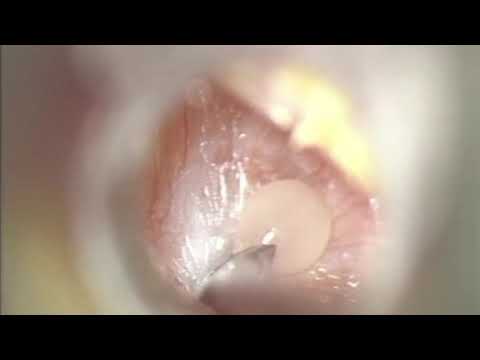 Contribution of External Ear Bacterial Reservoirs To Otitis Media With Effusion