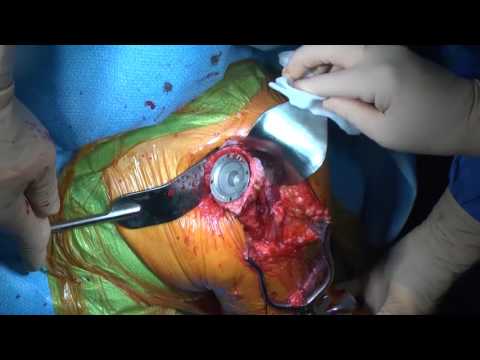 Patient Matched Implementation for Reverse Total Shoulder Arthroplasty