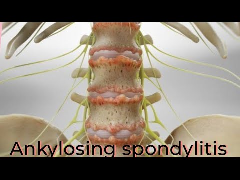 Ankylosing spondylitis #define symptoms #causes #Medical Field