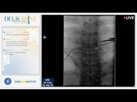 Watch Live Back Treatment! DPR RT T7, T8, T9, T10, T11