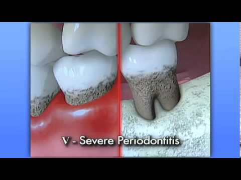 Types of Gum Disease - 5 stages.mov