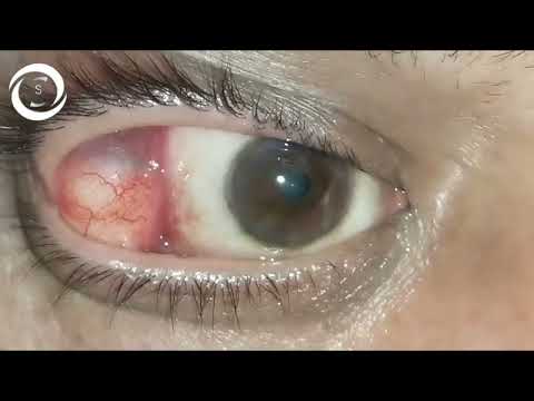 Massive Conjunctival Mass