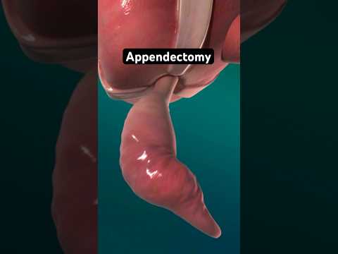 Appendectomy Explained (3D Animation)