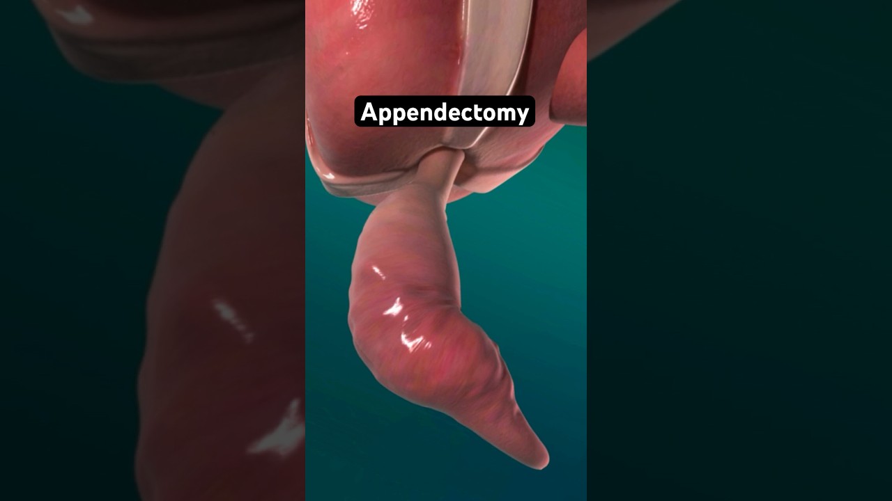 Appendectomy Explained (3D Animation)