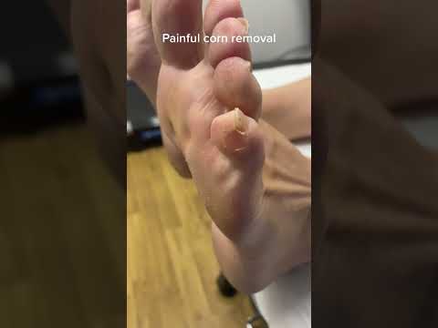 "Experience instant relief! Watch an Aussie podiatrist tackle a stubborn toe corn.#PodiatryMagic