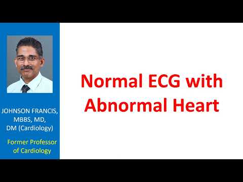 Normal ECG with Abnormal Heart