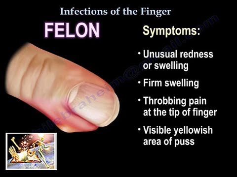 Infections of the Finger – Dr. Nabil Ebraheim's Blog