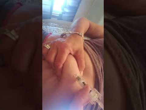 First stelara injection for psoratic arthritis (psa)