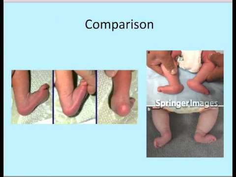 Congenital Vertical Talus