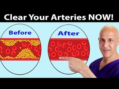 Eat These Foods to Clear Arteries FAST (Stop Heart Attacks & Strokes) Dr. Mandell