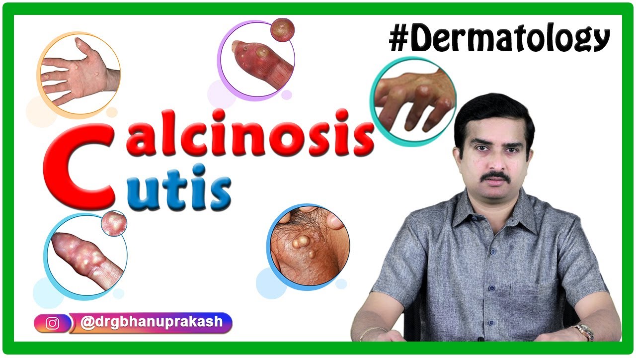 Calcinosis cutis - Dermatology #clinicalessentials