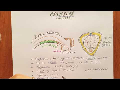 Hypospadias- clinical features