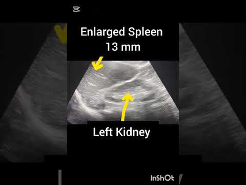 Ultrasound showing Enlarged Spleen!Left Kidney#ultrasoundmadeeasy86#radiology#sonography#viralshorts