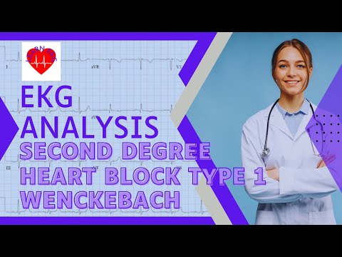 EKG Analysis: Second Degree Heart (AV) Block Mobitz Type 1 (Wenckebach)