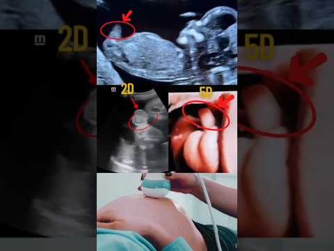 Baby Boy in the Womb | 2D/5D Ultrasound Magic Caught on Camera!
