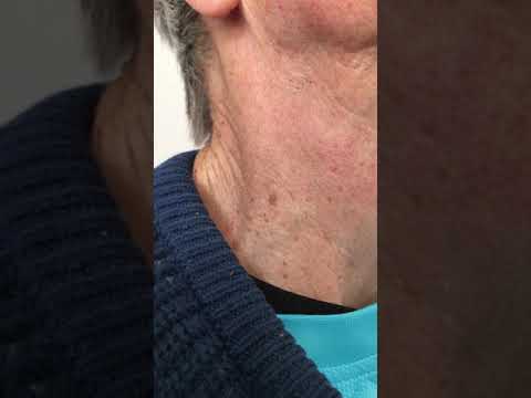 Severe Tricuspid Valve Regurgitation (TR) - V wave