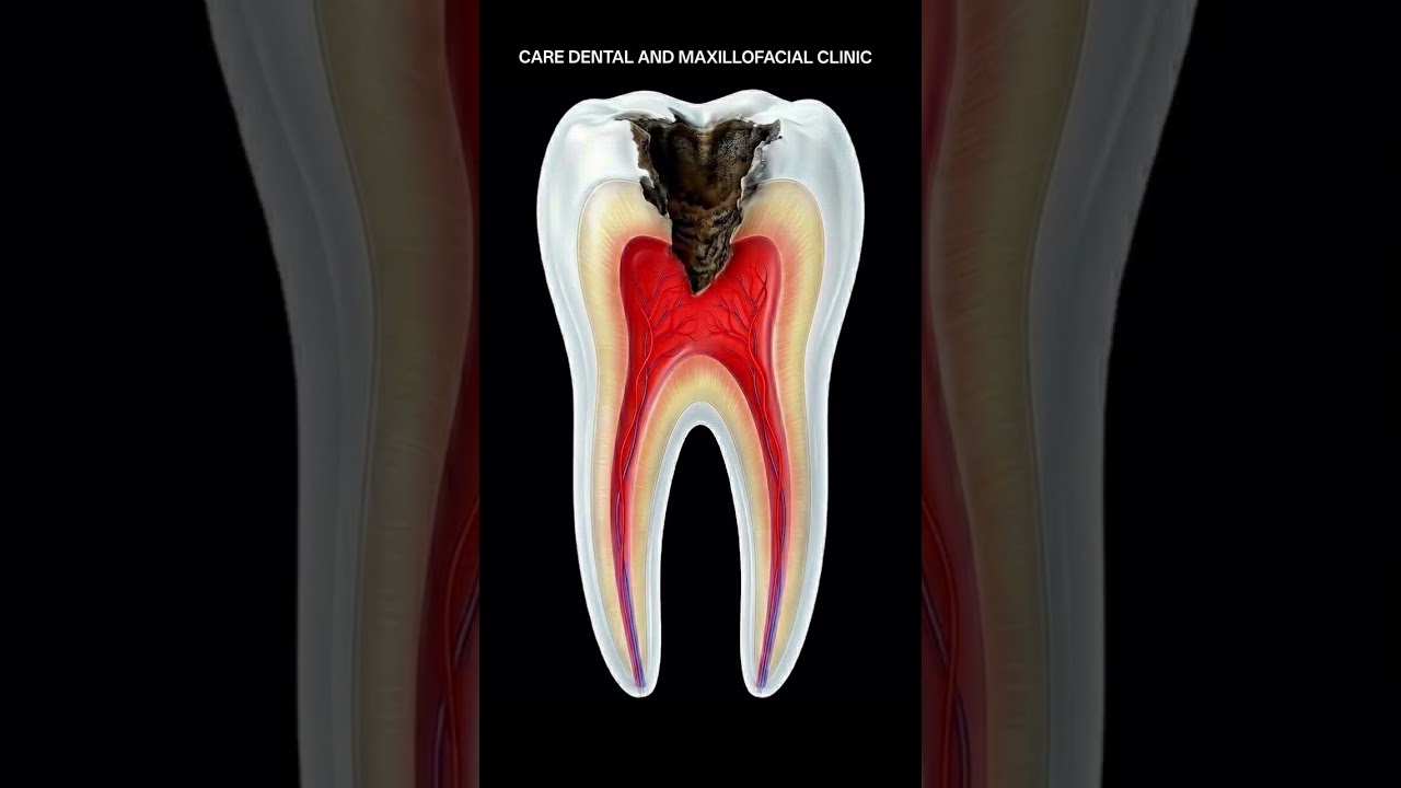 PROGRESSION OD DENTAL CARIES THROUGH  STAGES. #dentist #dentalclinic #orthodontist #teethdecay