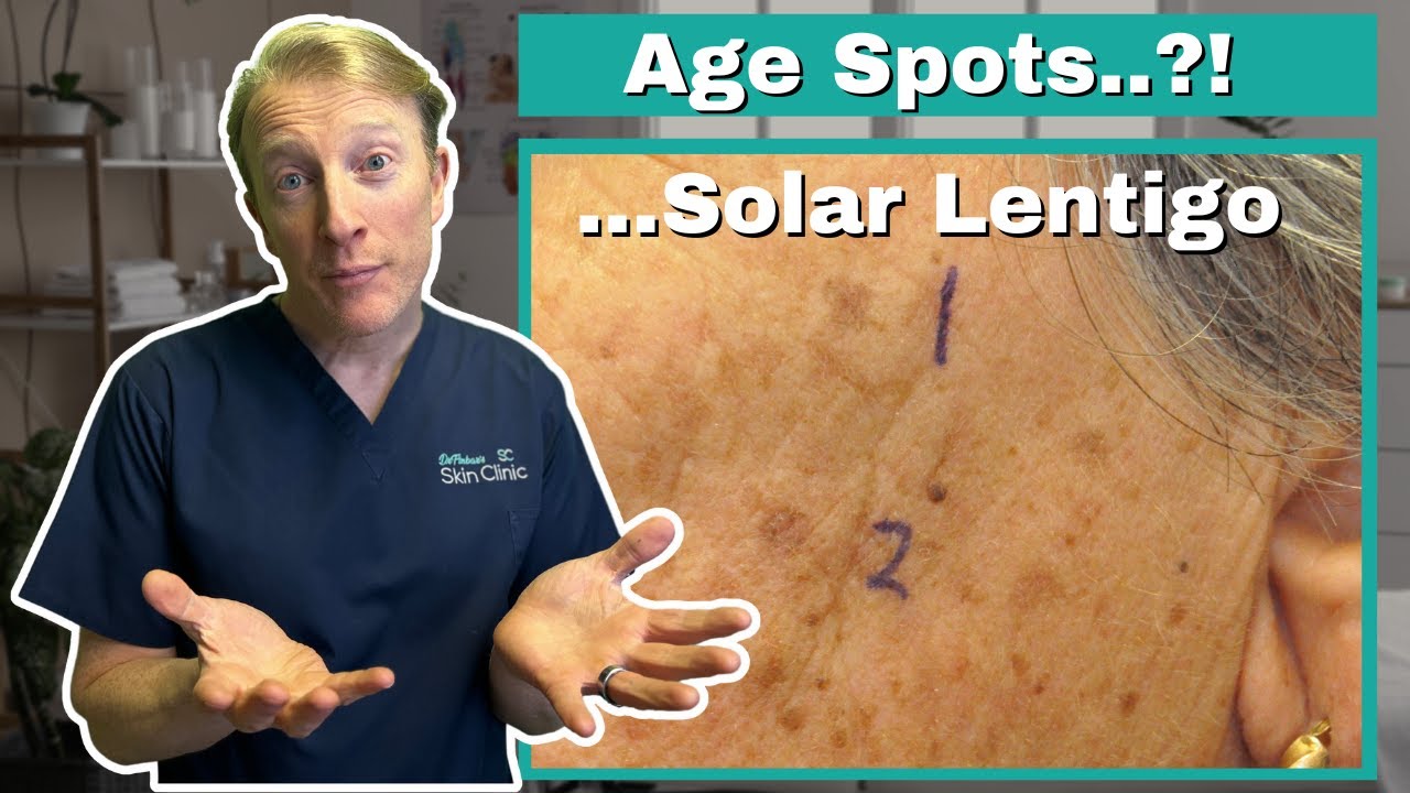 Age Spots: Getting Rid of Solar Lentigo