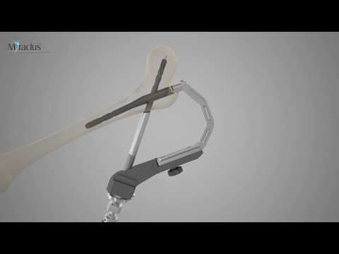 PFNA Nail Surgical Technique - Animation Created By Kems Studio (www.kemsstudio.com)