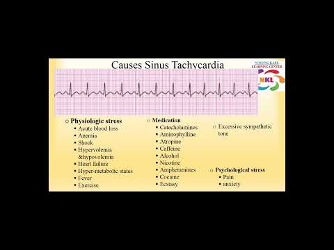 Sinus Tachycardia