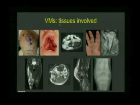 Vascular Malformation - Part4