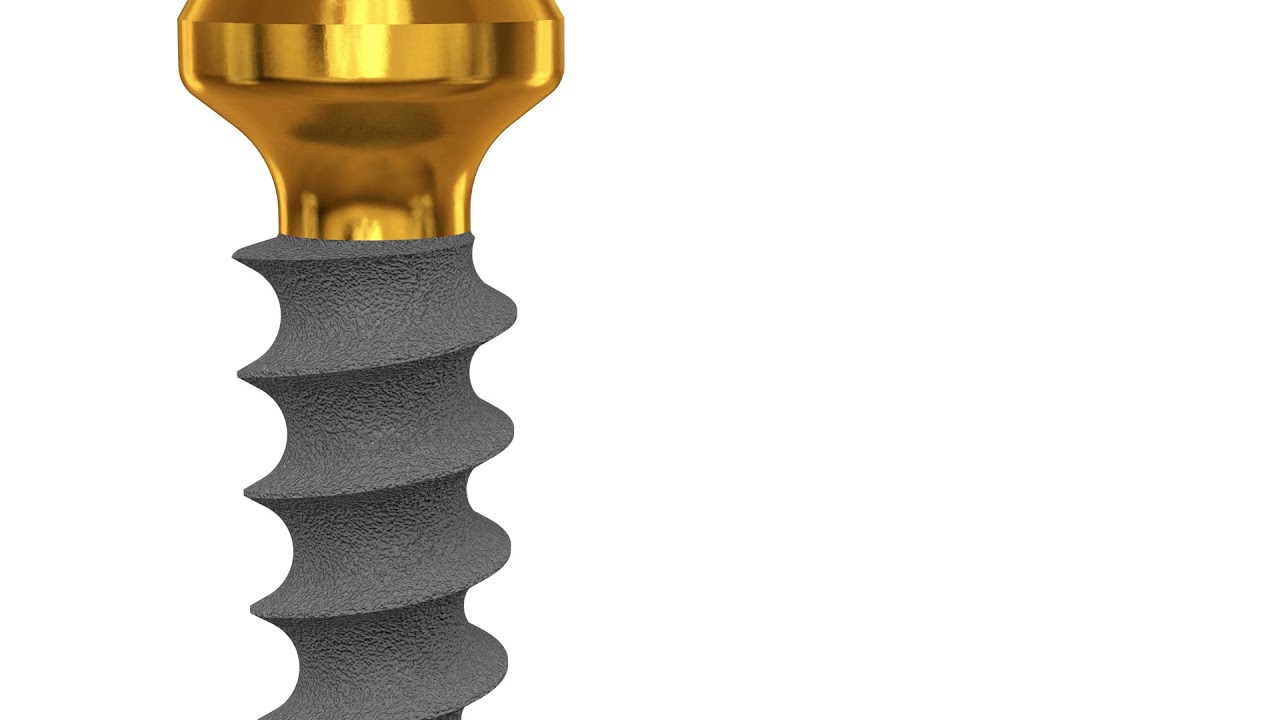 Compressive MS   Implant overview   V1