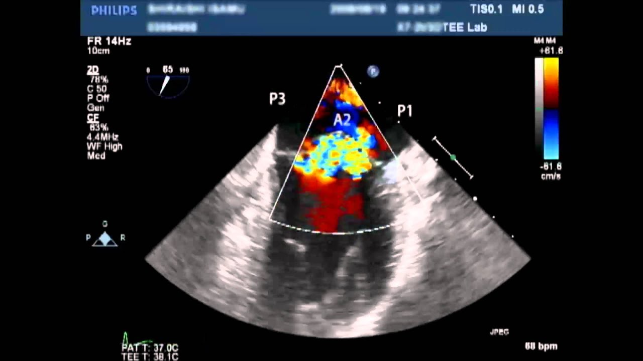 A2 ME mitral commissural CD