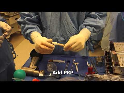 Cartilage Transplantation of the Glenoid in the Shoulder