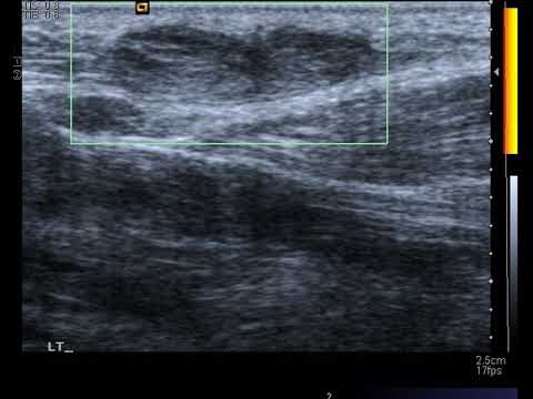 Plantar fibromatosis