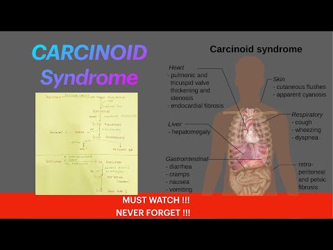 Carcinoid Syndrome | Causes | Symptoms | Diagnosis | Treatment | Carcinoid Tumor Serotonin