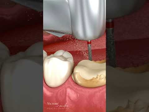 ASMR: Ceramic Crown Restoration #dentist #dentalcrown #oralheath #animation #asmr #shorts #ytshorts