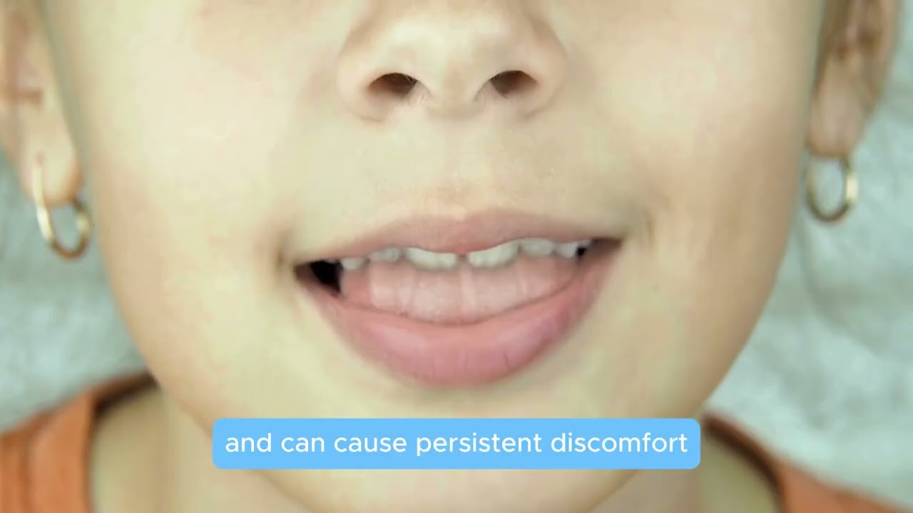 Sore Lingual Frenulum: Top Causes and How to Treat it